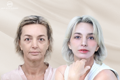 Are There Effective Treatments for Skin Laxity? Medical Options Explained